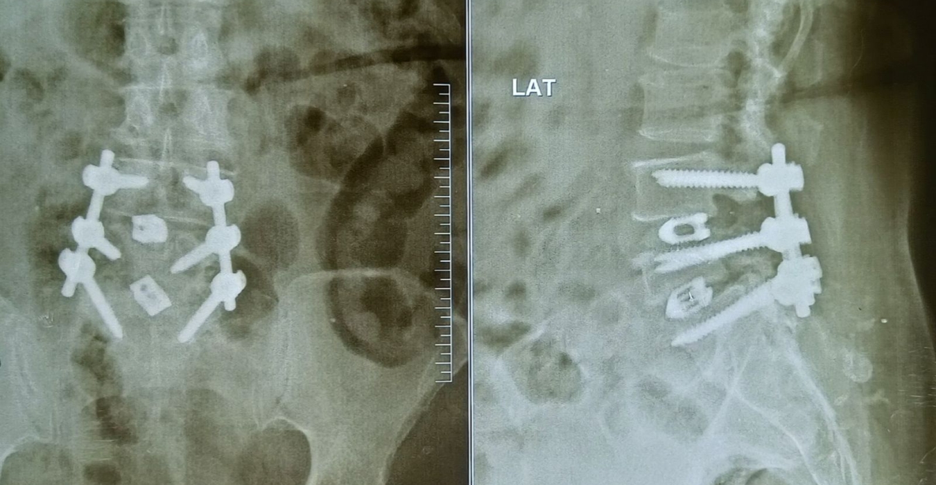 Lumbar Spine Decompression Surgery in Thane | Dr. Sagar Kokate